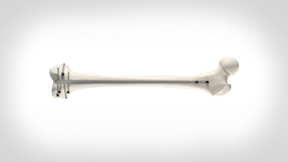 Stryker Launches T2 Alpha Femur Retrograde Nailing System | OR Today